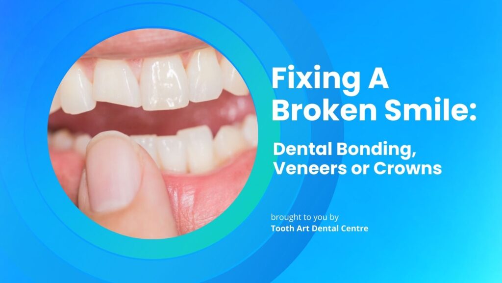 Tooth Art Dental Centre - Dental Bonding, Veneers or Crowns